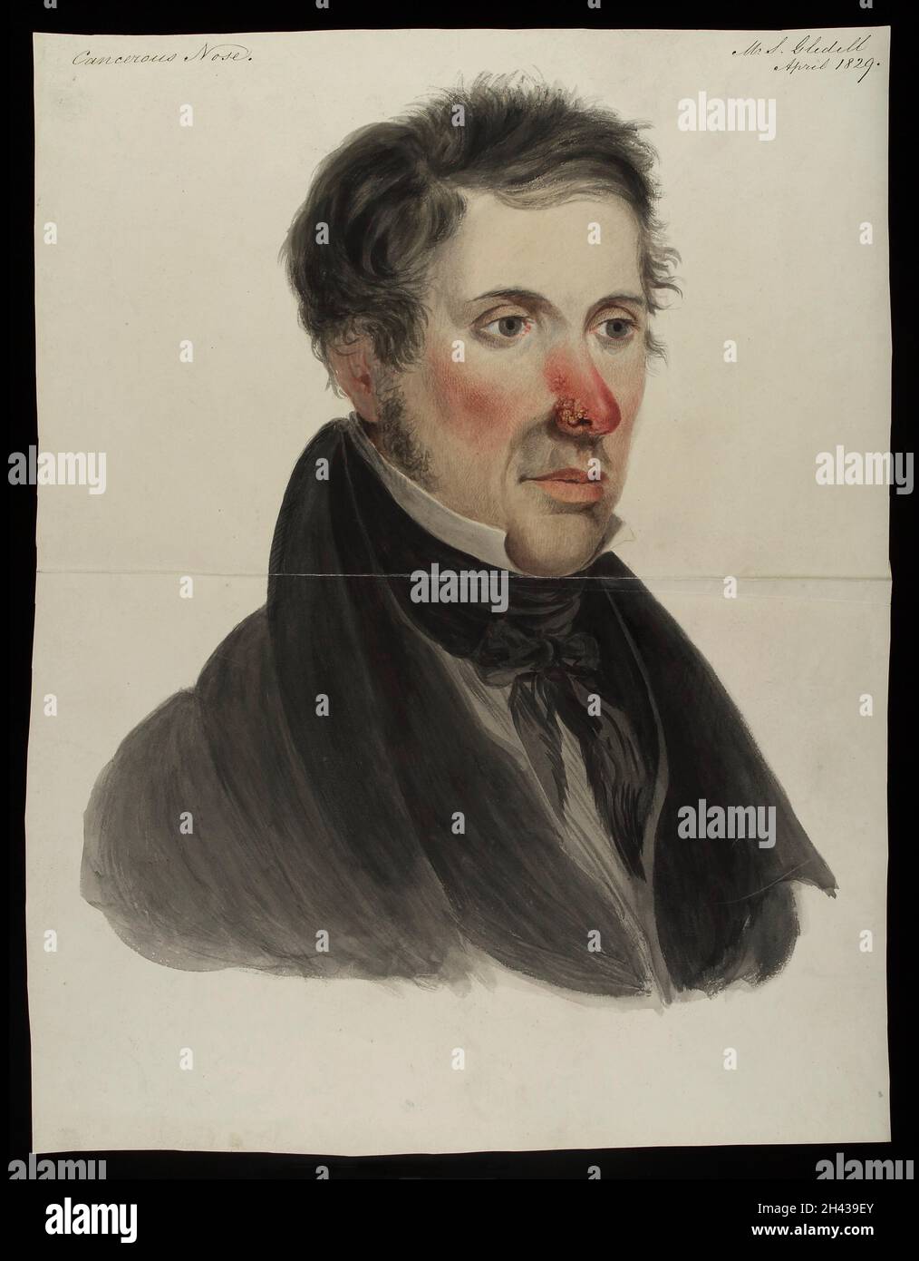 Mr Gledell, suffering from a rodent disease which has consumed his left ...