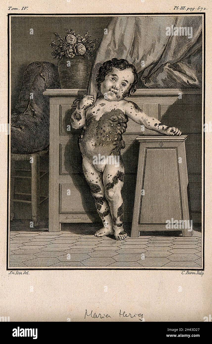 Maria Herig, a girl with a skin disease identified as multiple fibroma ...