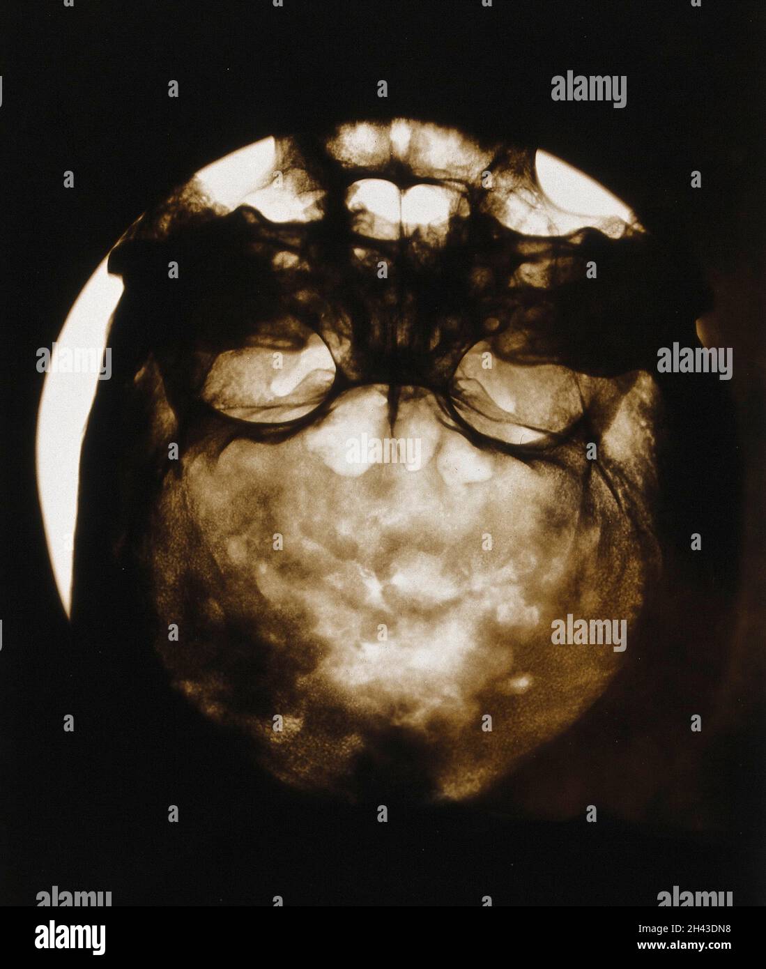 An Alaskan Inuit skull, showing the effects of syphilis. Photograph of ...