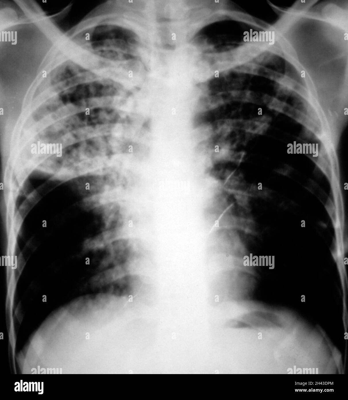 Nocardia Black and White Stock Photos & Images - Alamy