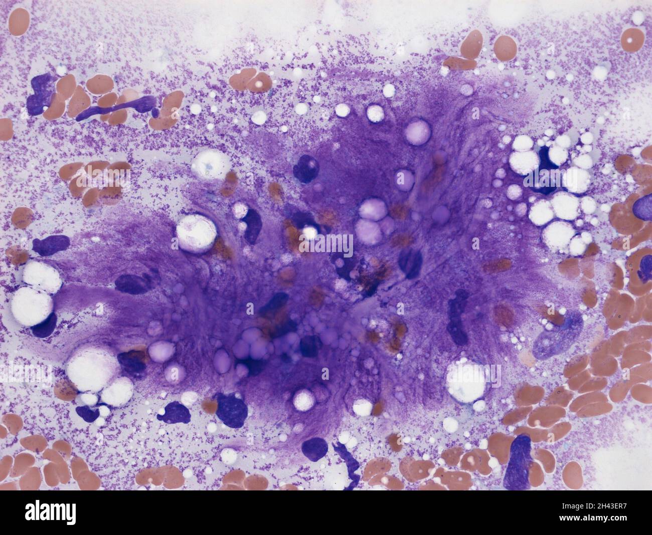 Myxoid liposarcoma, microscopy Stock Photo - Alamy