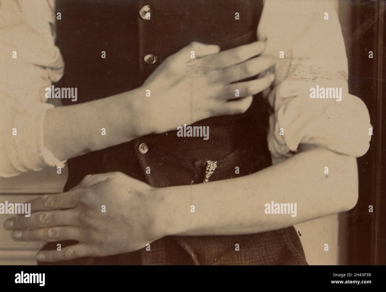 Forearms and hands of a boy suffering from paralysis of the right ulnar ...