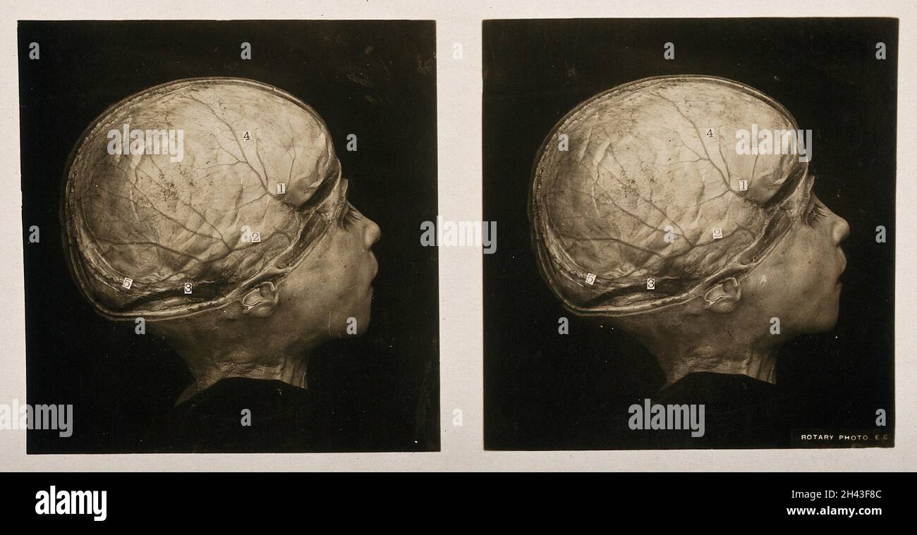 Anatomy: a head with the skull removed showing meninges. Photograph, ca ...