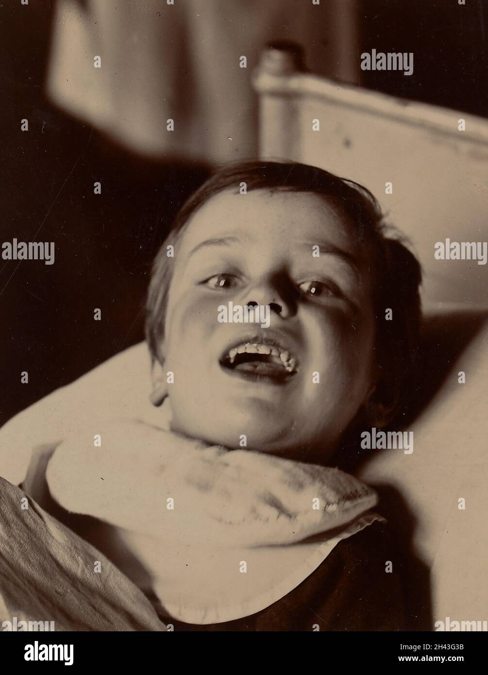 Child possibly suffering from diphtheritic paralysis of the lips and ...