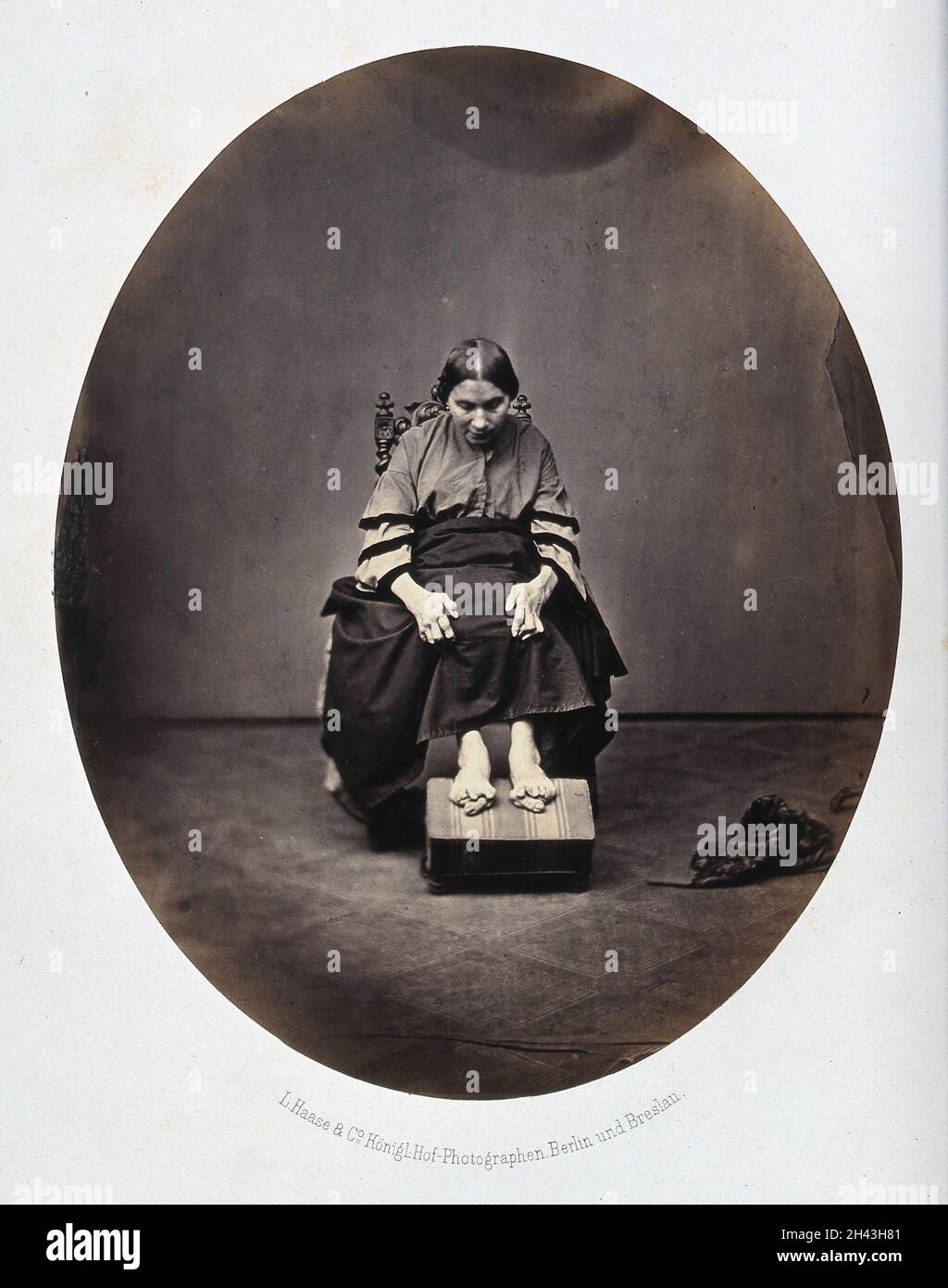A sitting woman, her fingers and toes are severely deformed. Photograph ...