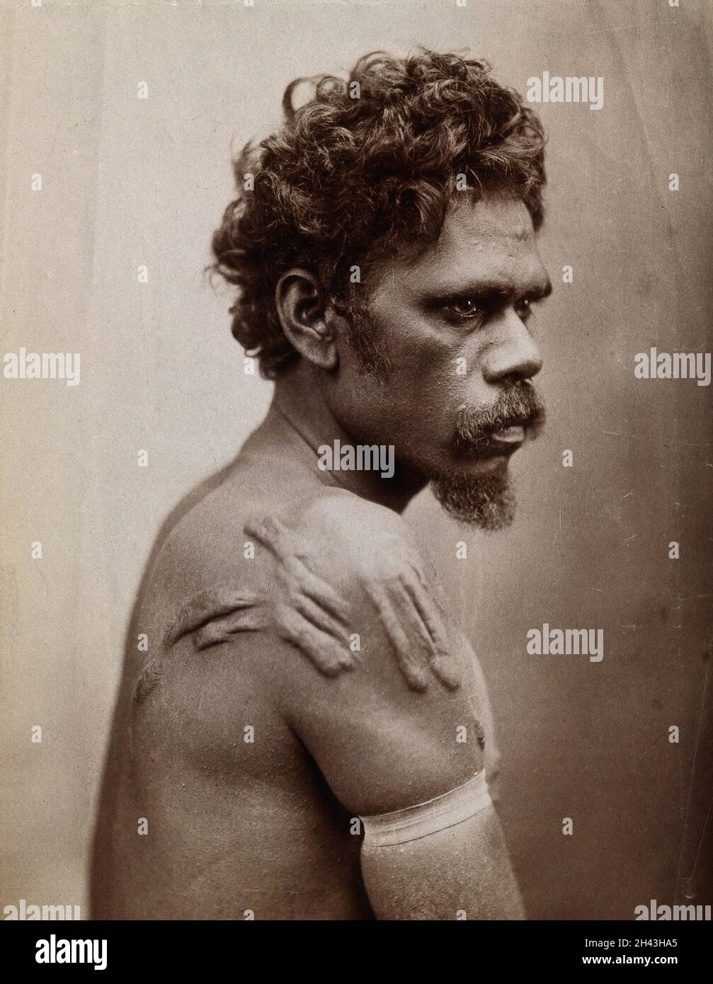 Skin scarification hi-res stock photography and images - Alamy
