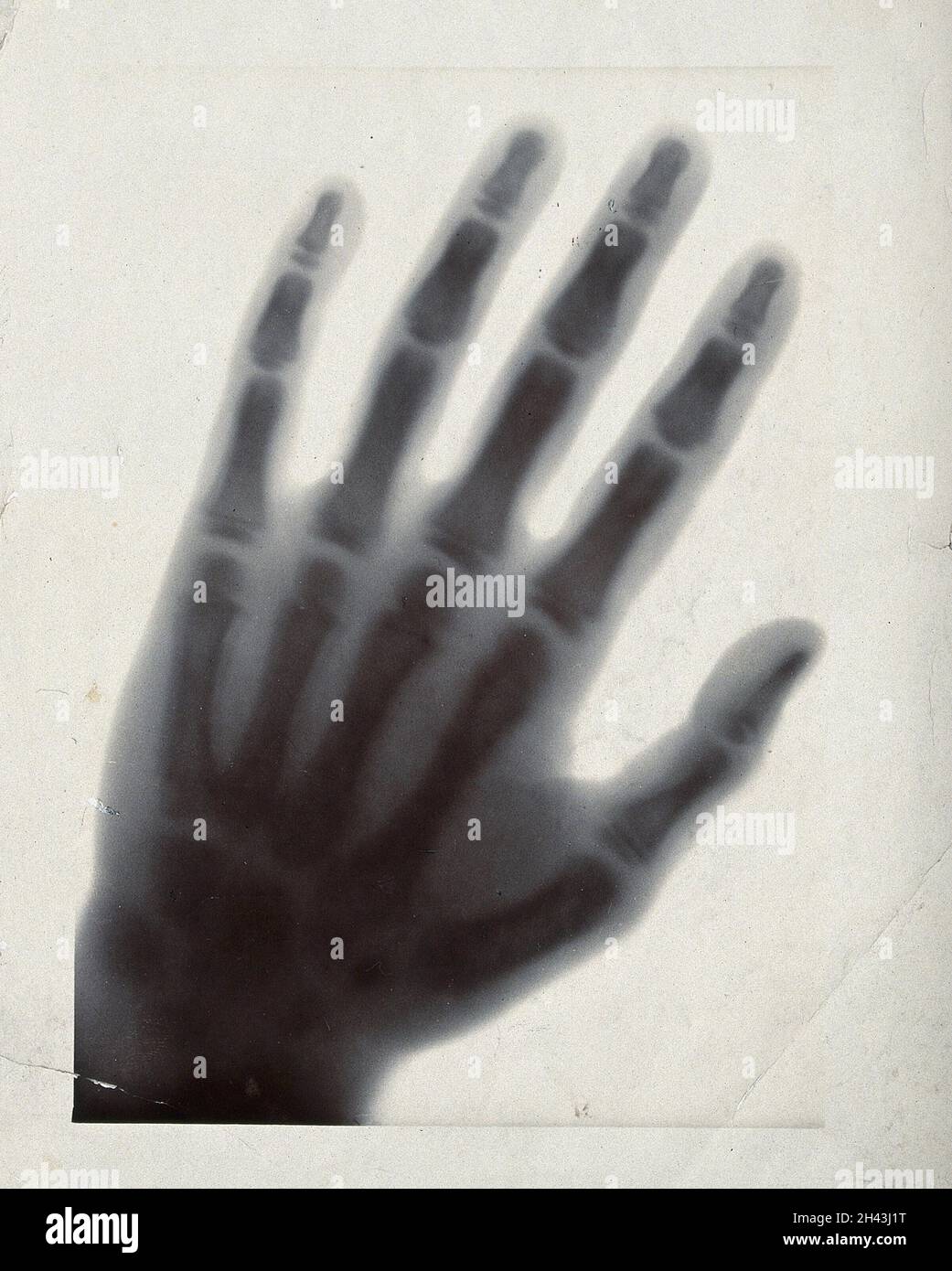 The bones of a hand, viewed through x-ray. Photoprint from radiograph ...