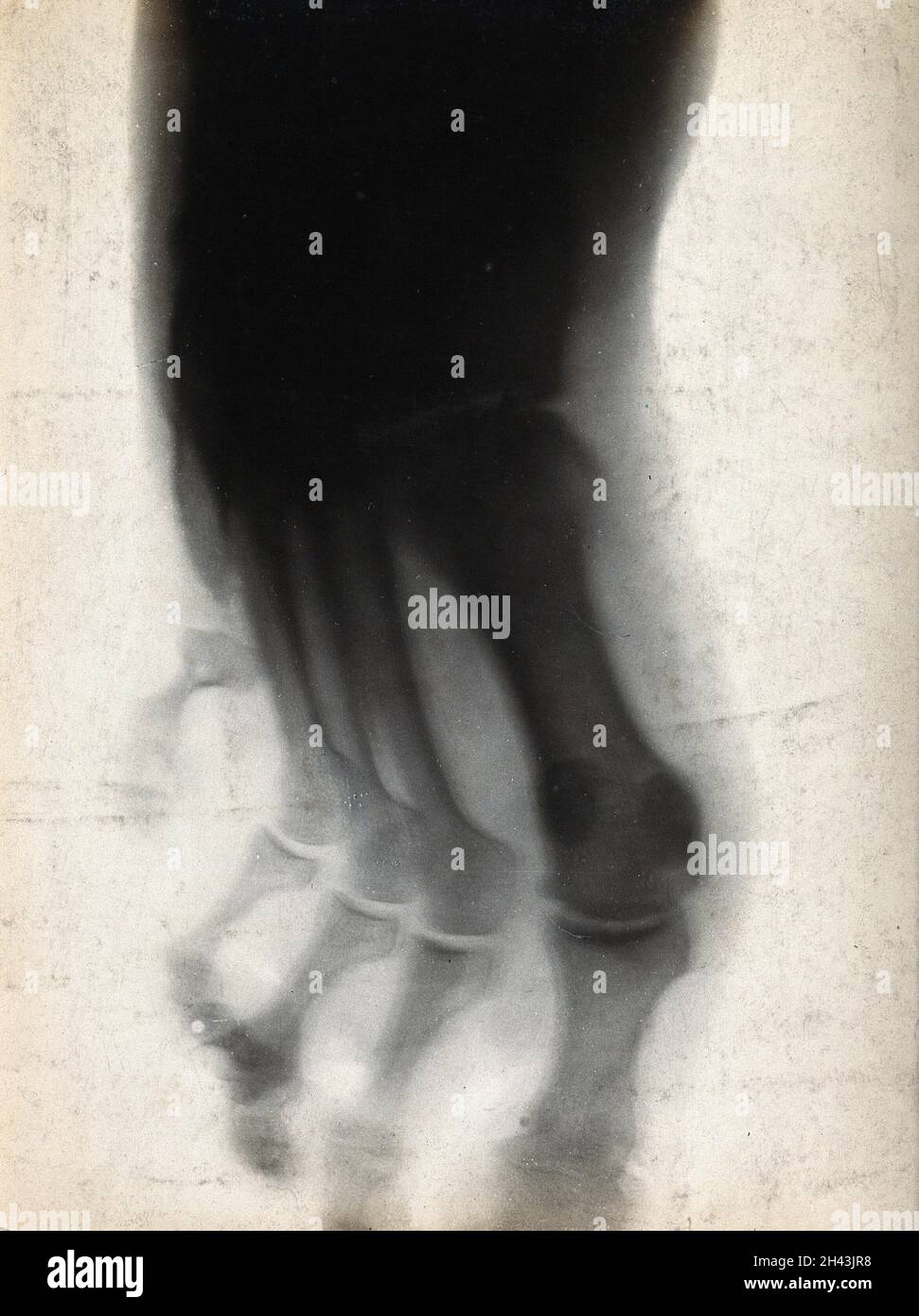 The bones of a foot, viewed through x-ray. Photoprint from radiograph ...
