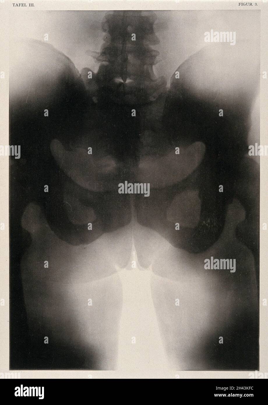 A woman's pelvis after a succesful pubiotomy - a surgical incision of ...