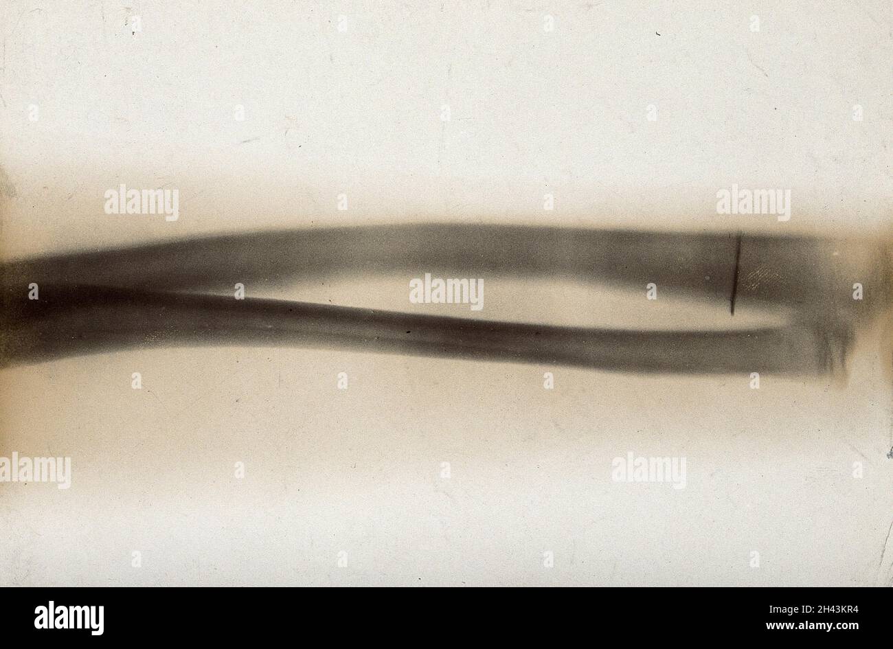 The bones of the radius and ulna, viewed through x-ray. Photoprint from ...