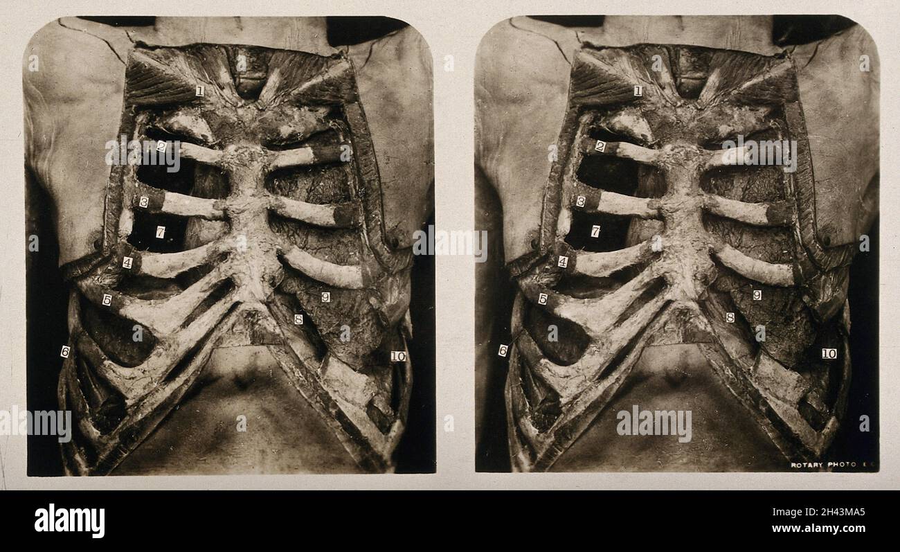Anatomy: a dissection of the thorax showing the heart, pericardium ...