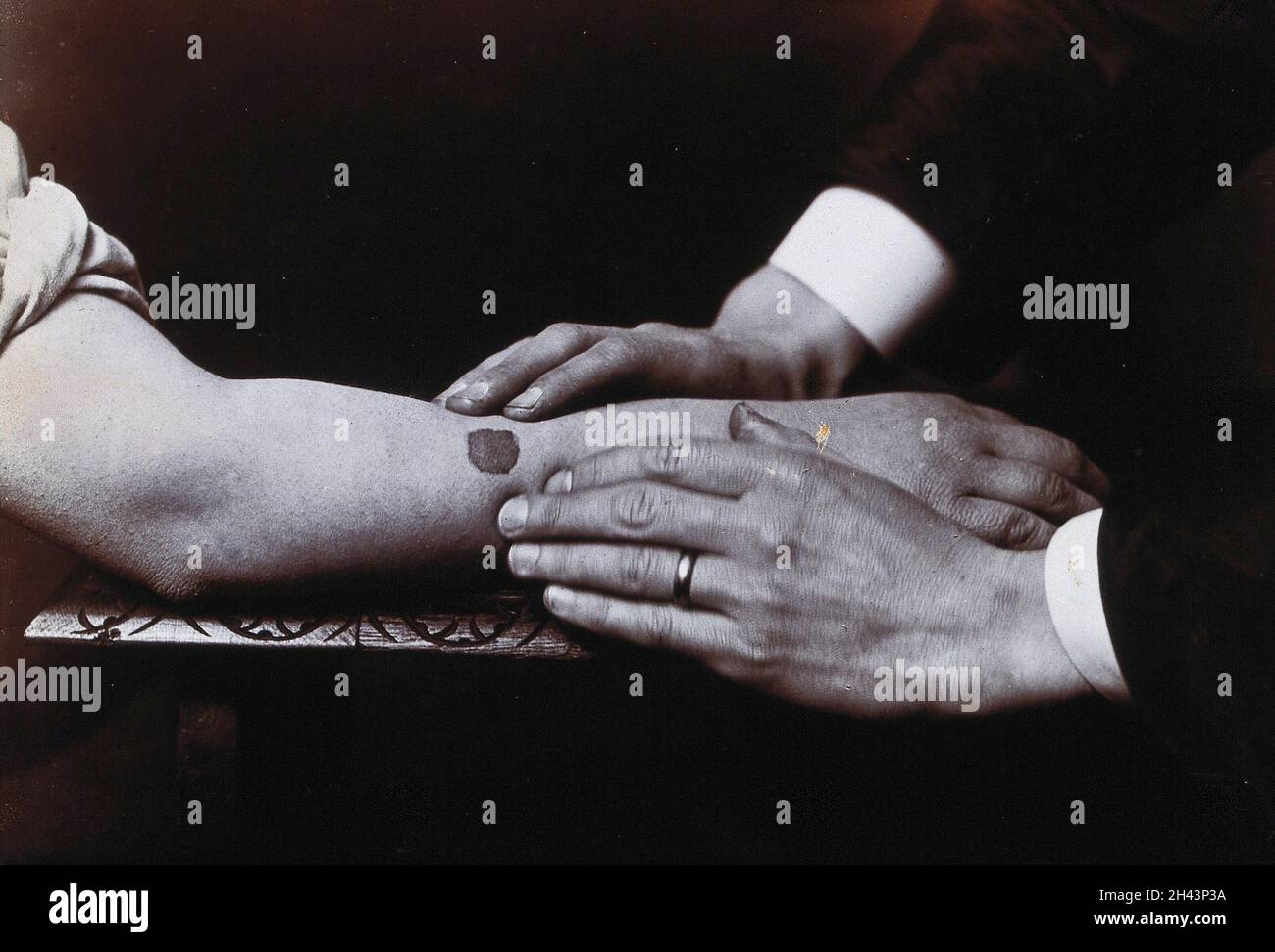 Two hands held on either side of a dark mark on a forearm, to ...