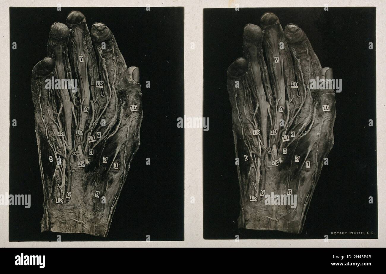 Anatomy: écorché palm of the hand showing muscles, nerves, vessels and ...