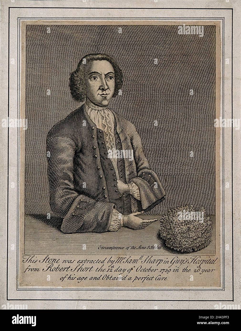 Robert Short, who had a bladder-stone removed which was eight inches in ...