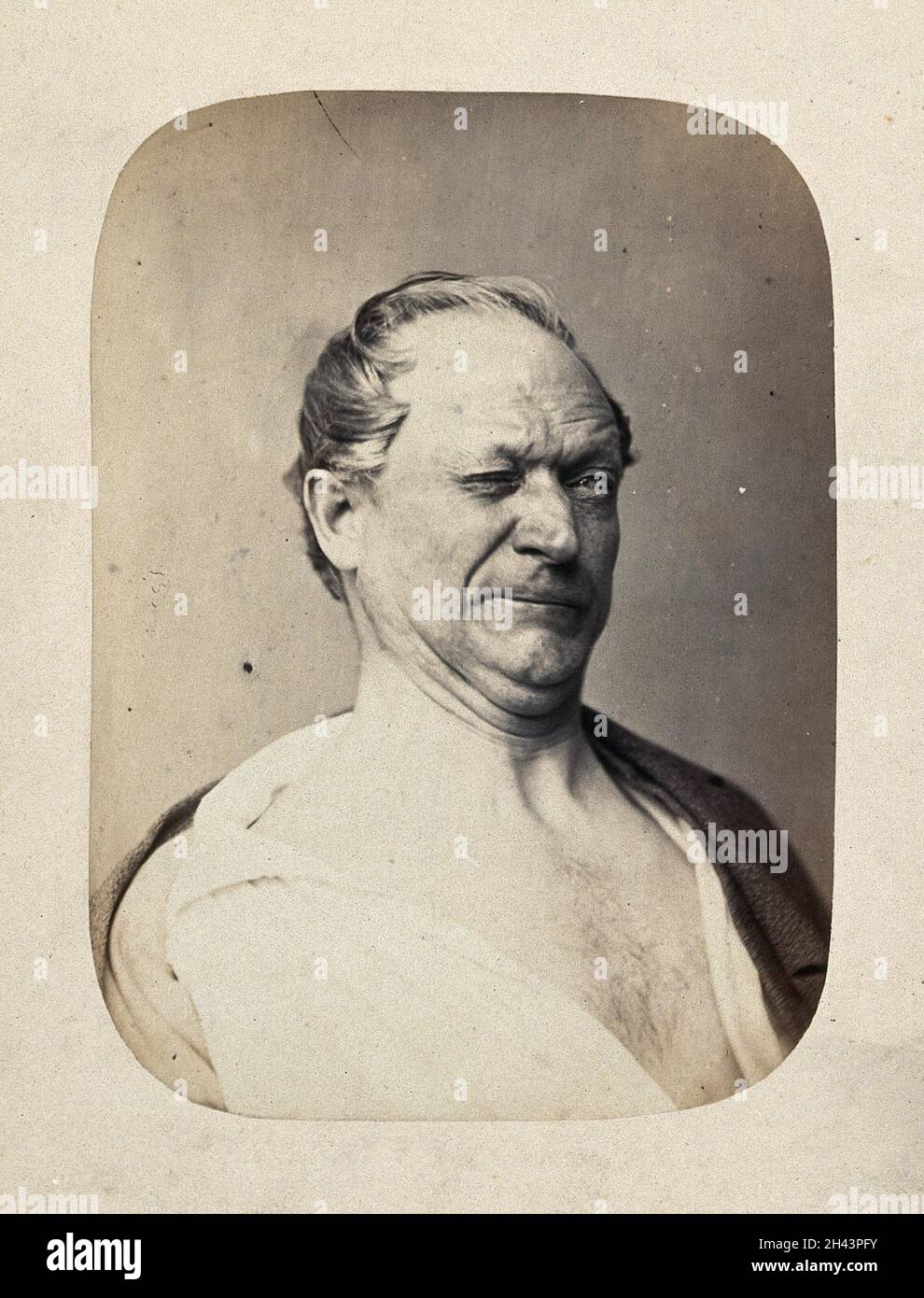 A man's head and shoulders, the right side of his face is contorted ...