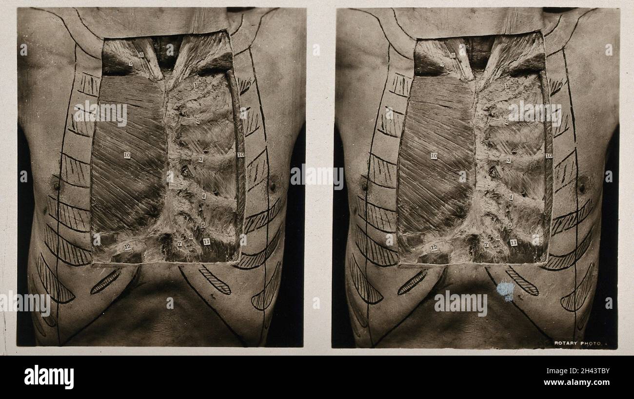 Anatomy: a dissection of the thorax: the anterior thoracic wall ...