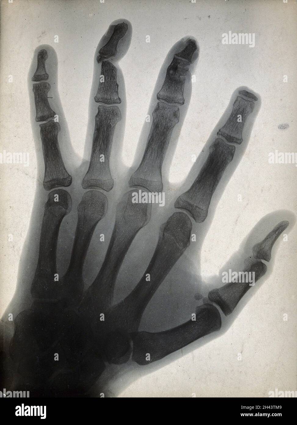 The bones of a hand, with the tip of the index finger missing, viewed ...