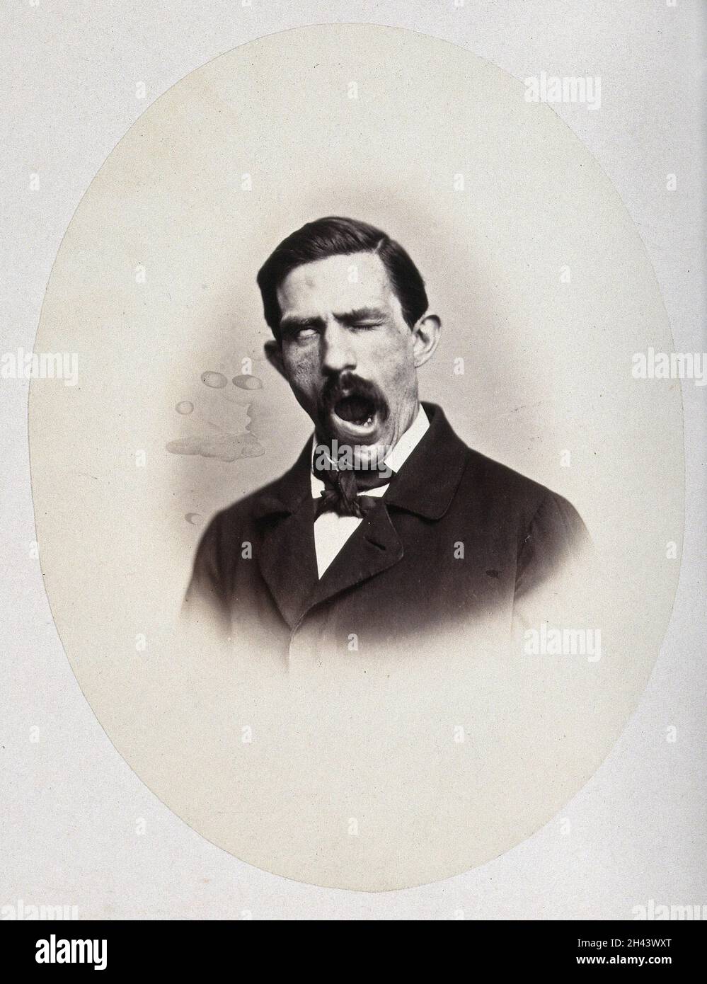 A man, head and shoulders; his face is contorted. Photograph by L ...