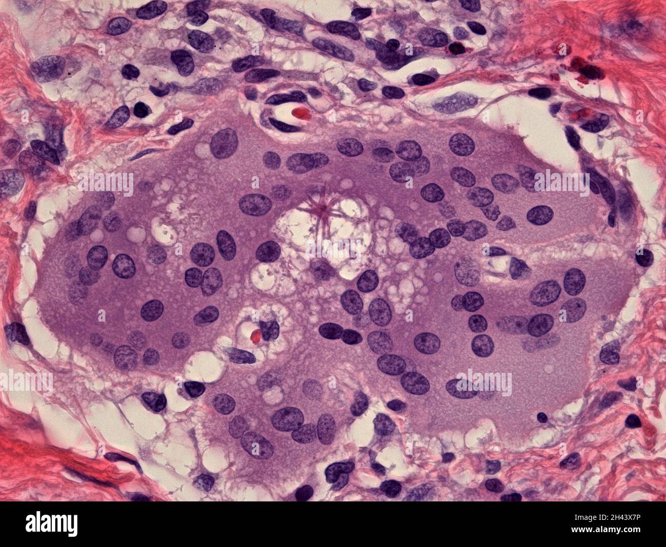 Multinucleated giant cell containing an asteroid, microscopy Stock ...