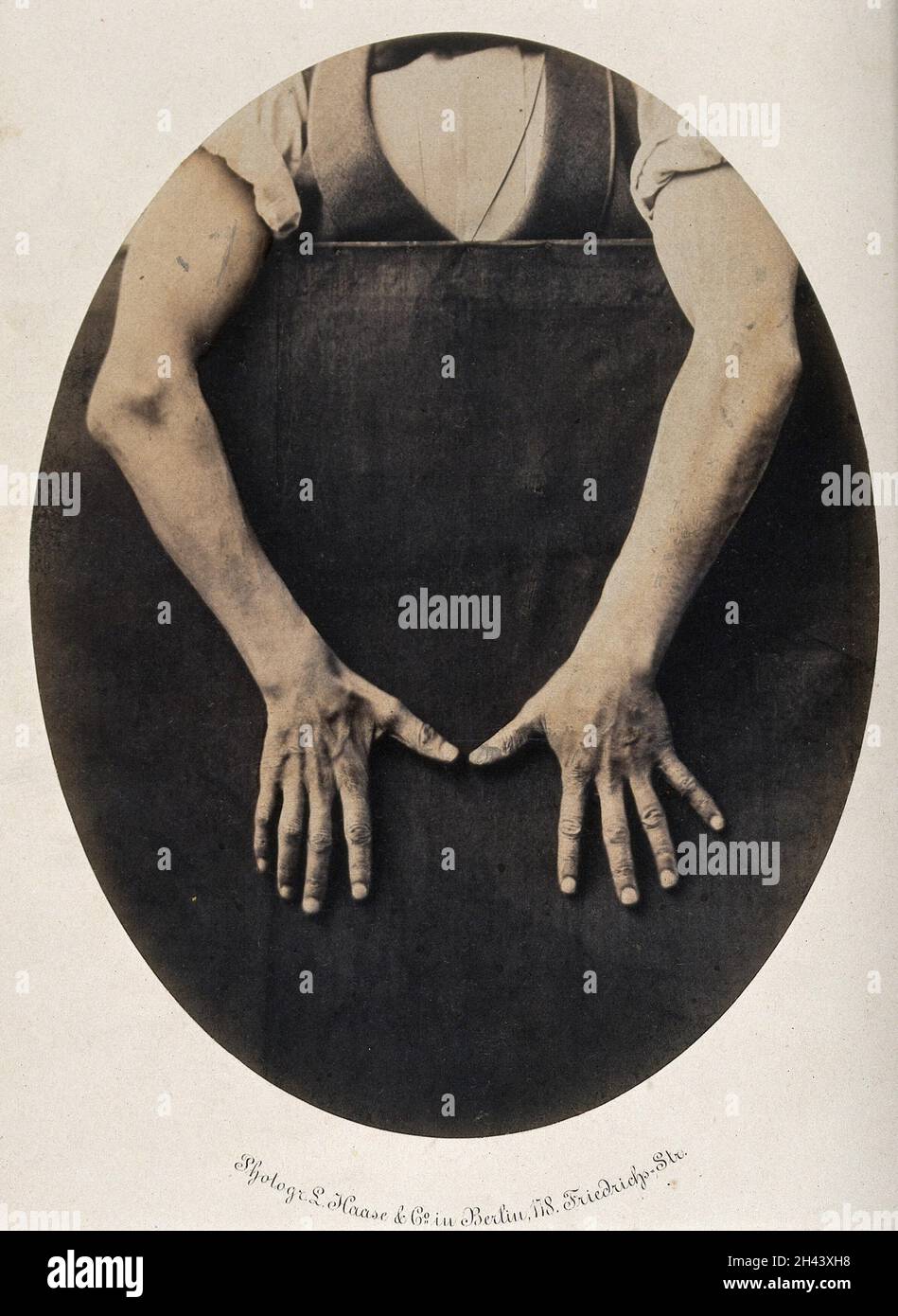 Wilhelm Haack, his hands and forearms exposed against a black ...