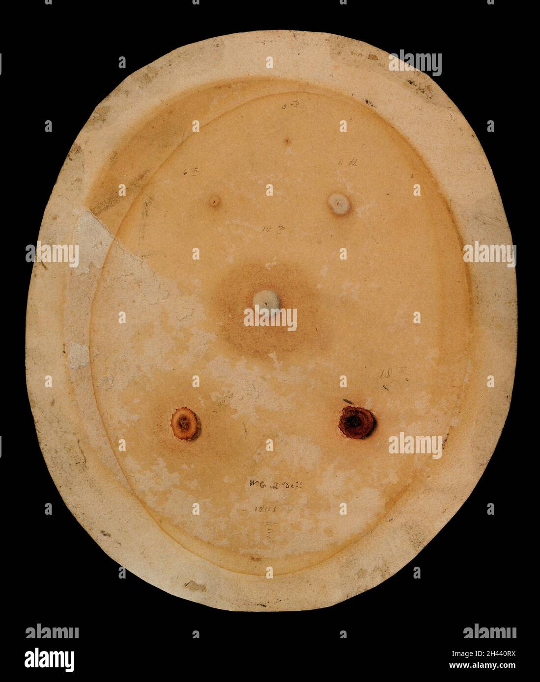 Cowpox pustules from the sixth to the eighteenth days of the disease ...