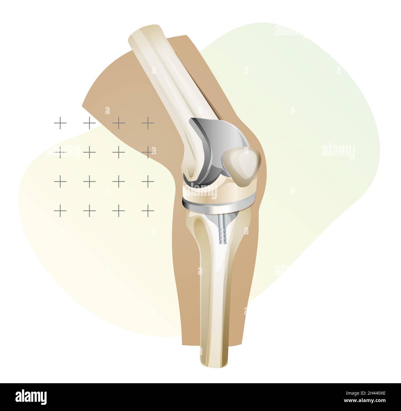 Knee joint replacement Stock Vector Images - Alamy