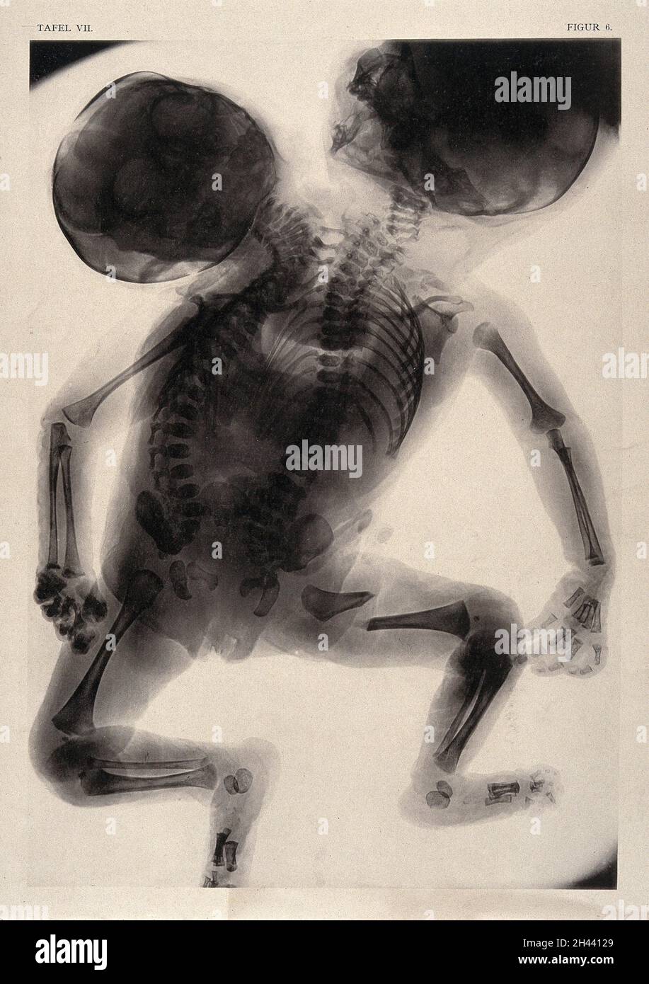A skeleton of a child born with two backbones and two heads. Collotype ...