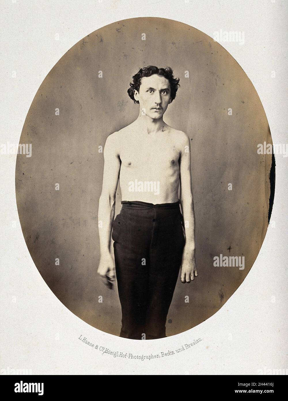 A standing man, 3/4 length view, partially clothed; his left arm ...