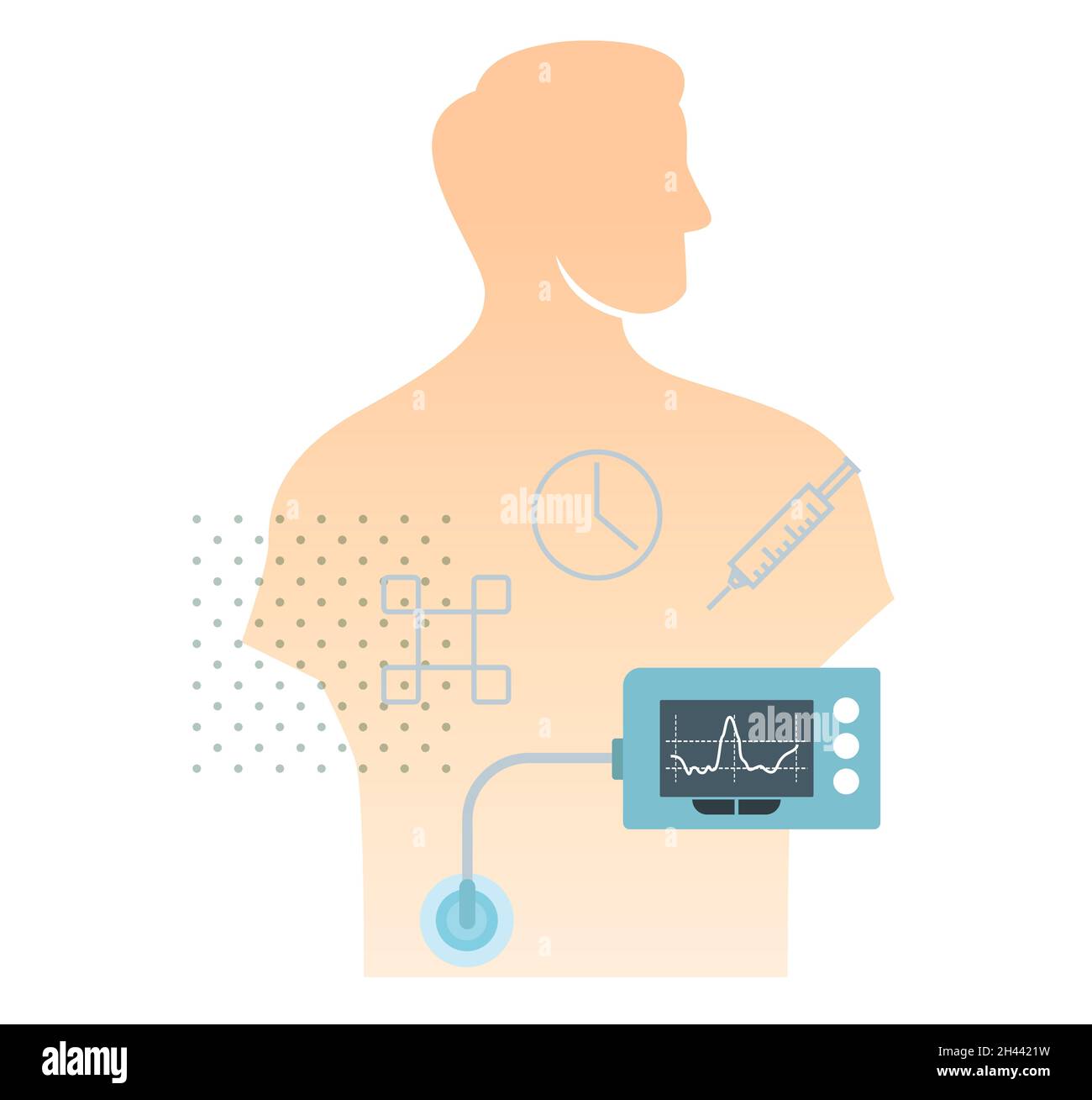 Insulin pump hi-res stock photography and images - Alamy