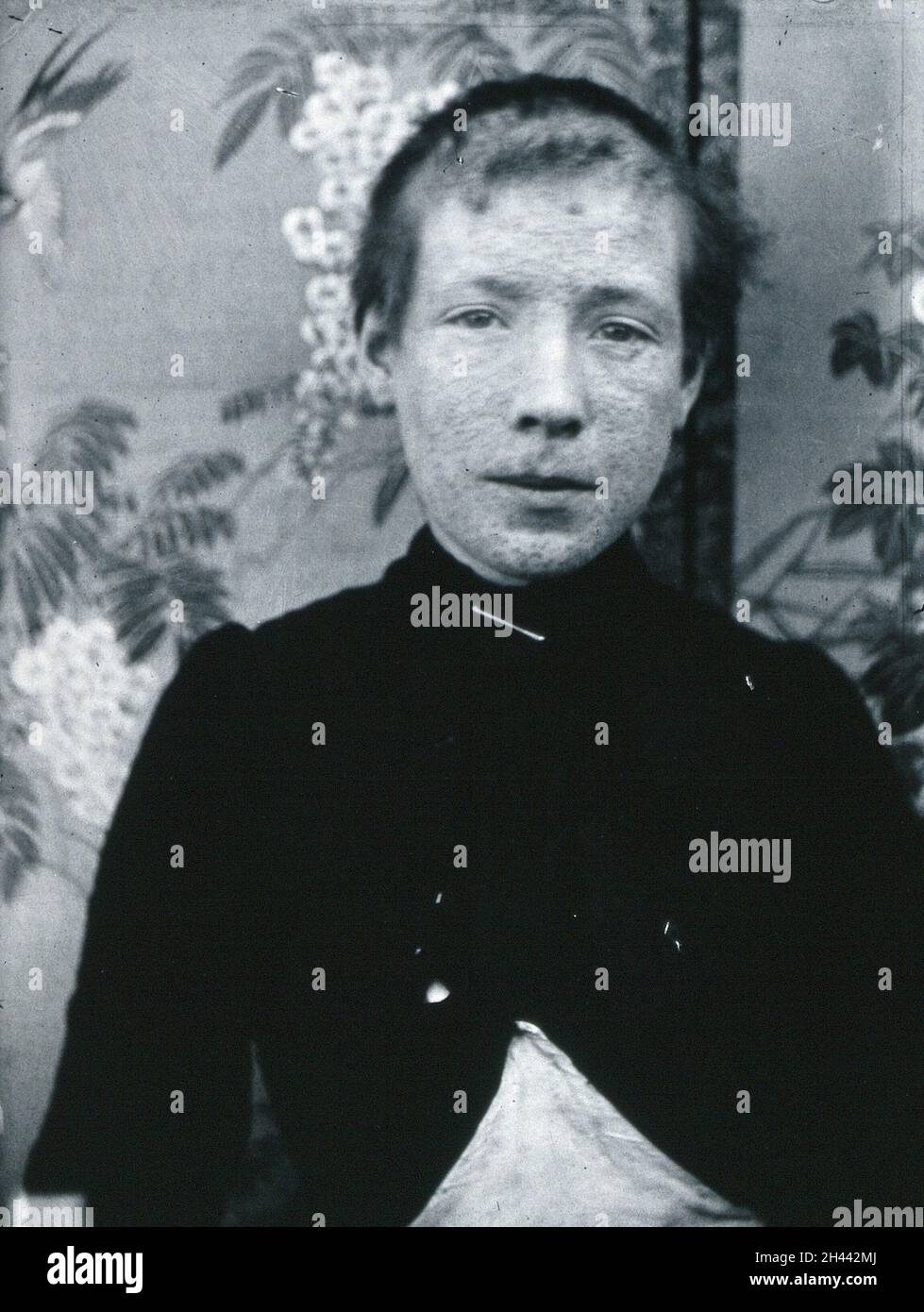Gloucester smallpox epidemic, 1896: Ethel Cromwell, aged about 14 years ...