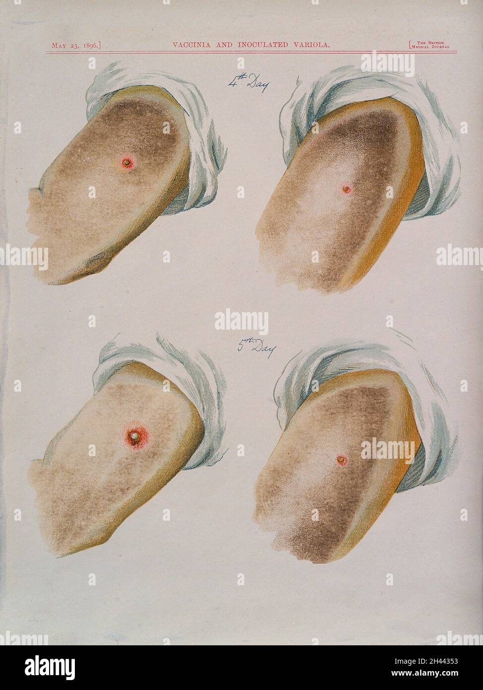 A comparison between smallpox and cowpox pustules on the 4th and 5th ...