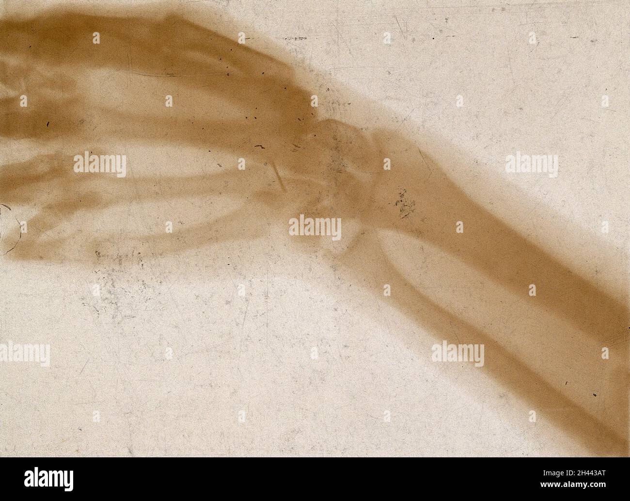 The bones of a hand and wrist, viewed through x-ray. Photoprint from ...