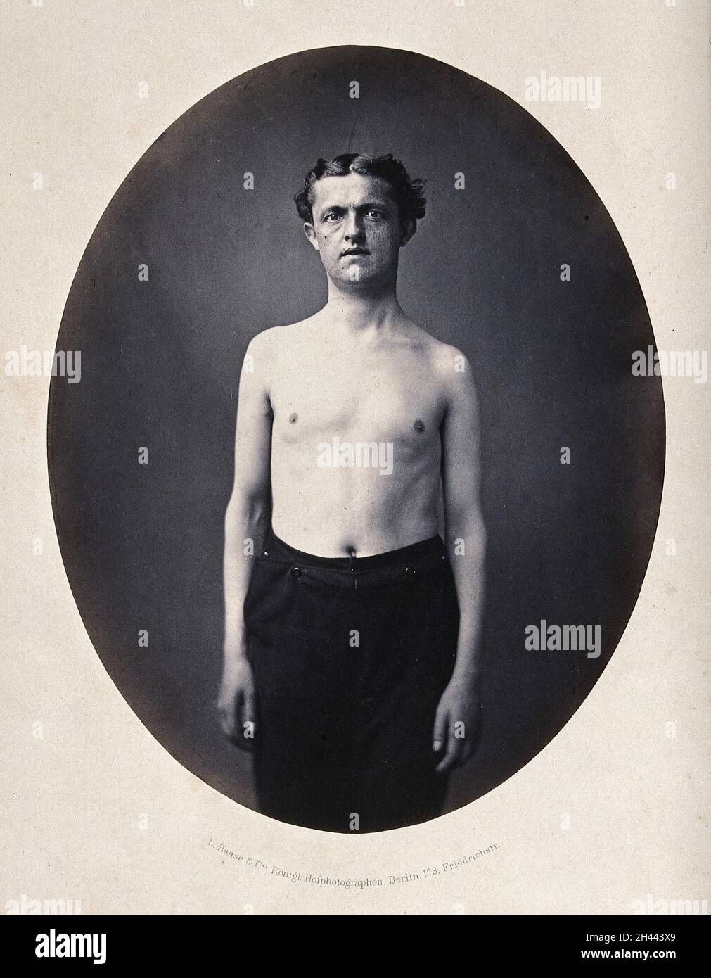 A partially clothed man, standing, viewed from the front; his left ...