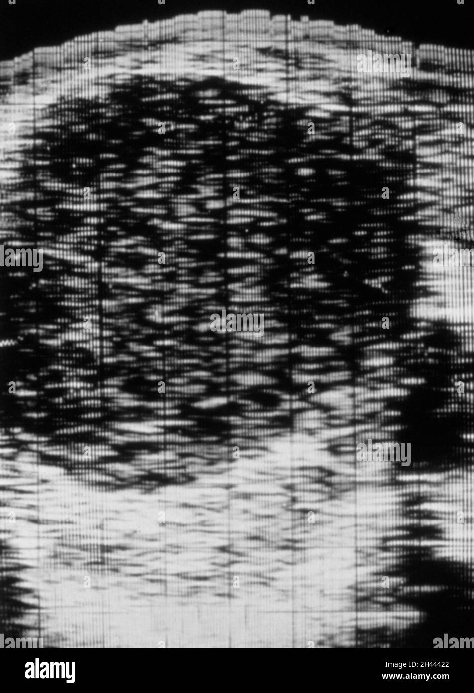 Amoebiasis: ultrasound scan of amoebic liver abscess Stock Photo - Alamy