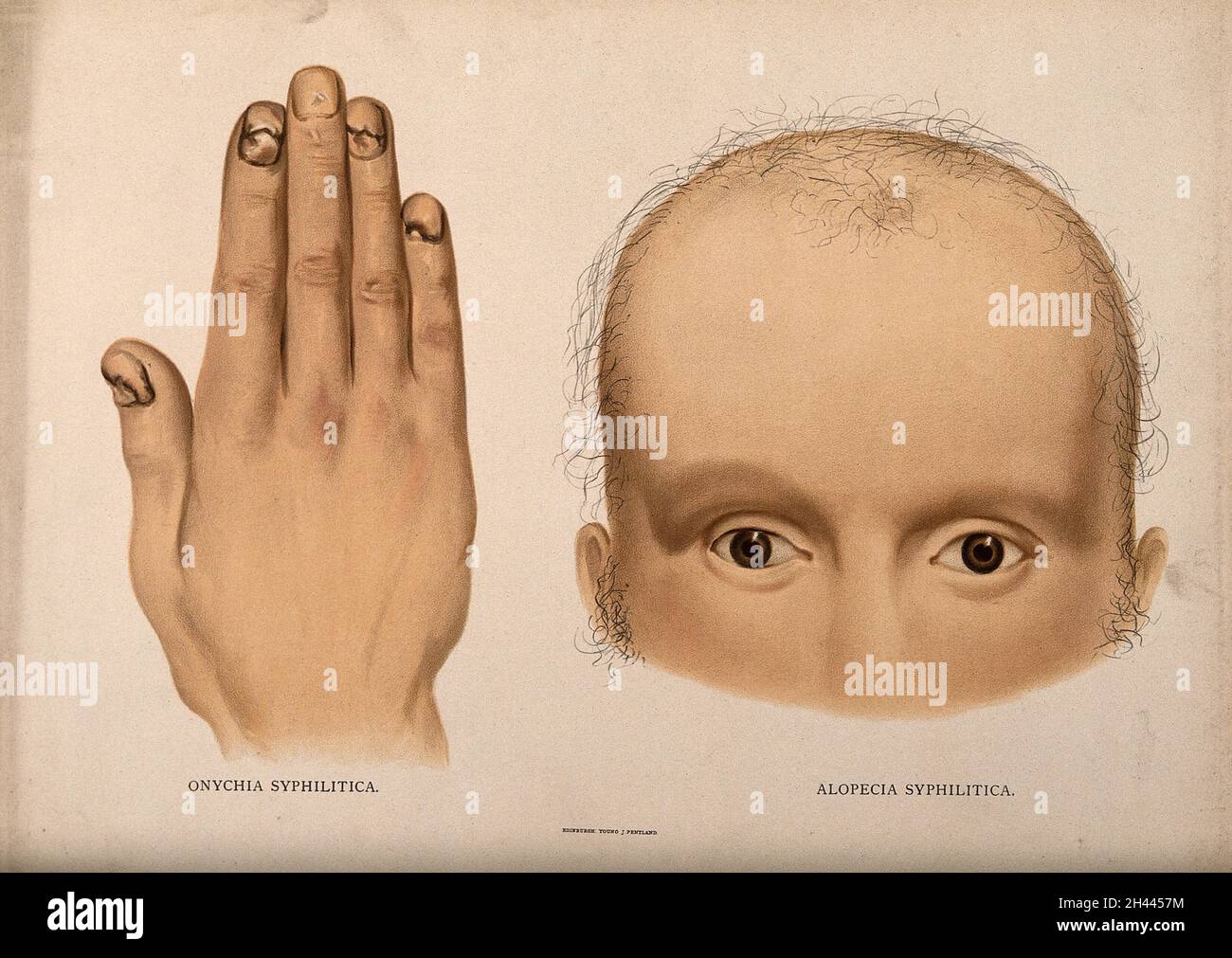 A Hand With Cracked And Diseased Fingernails And The Upper Half Of A