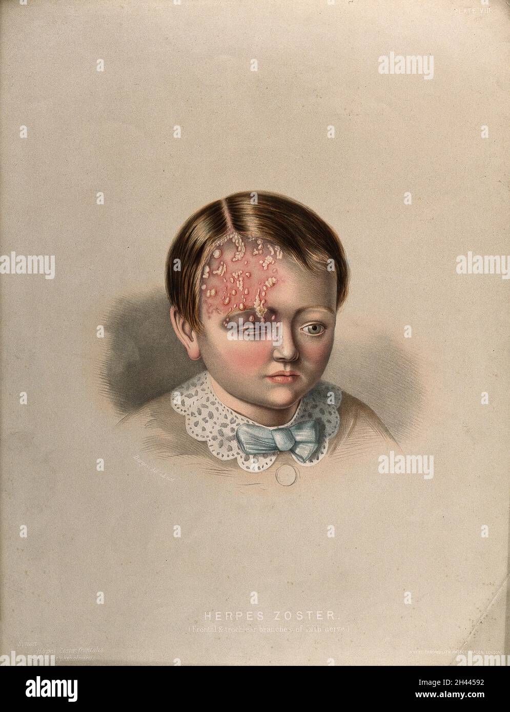 Diseased skin on the face and eye of a small boy suffering from herpes ...