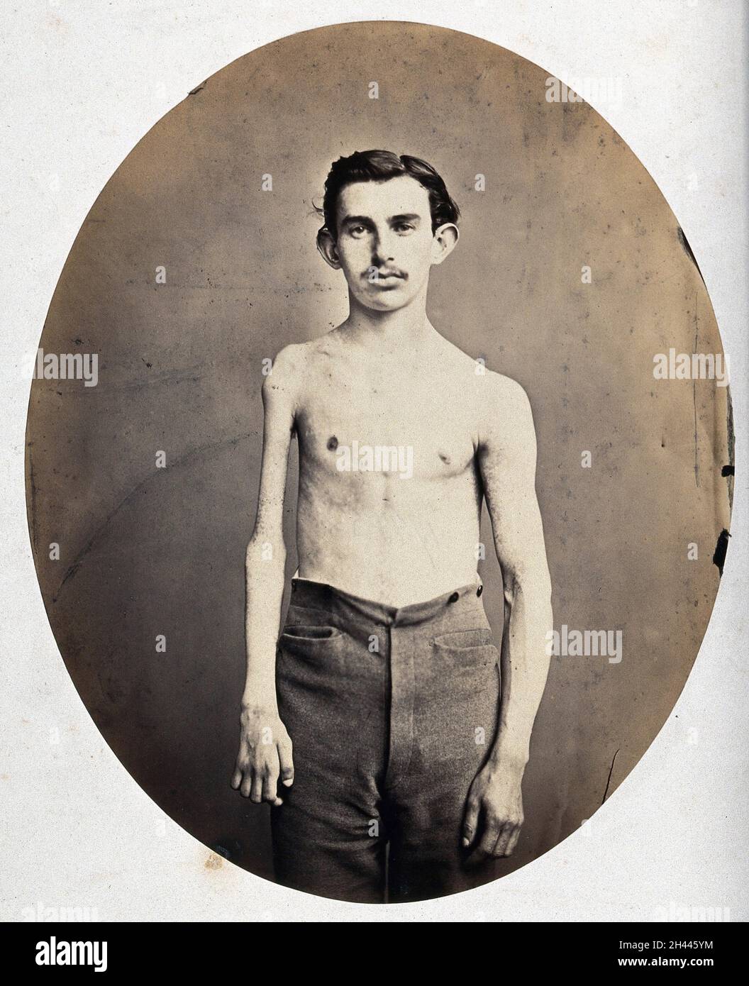 A partially clothed man, standing, viewed from the front; his right arm ...