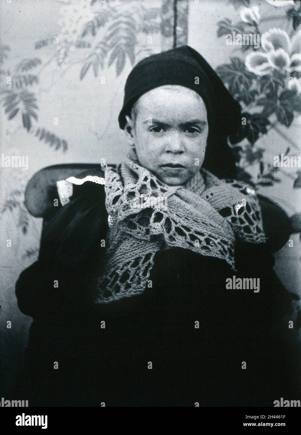 Gloucester smallpox epidemic, 1896: a child of the Beard family, as a ...