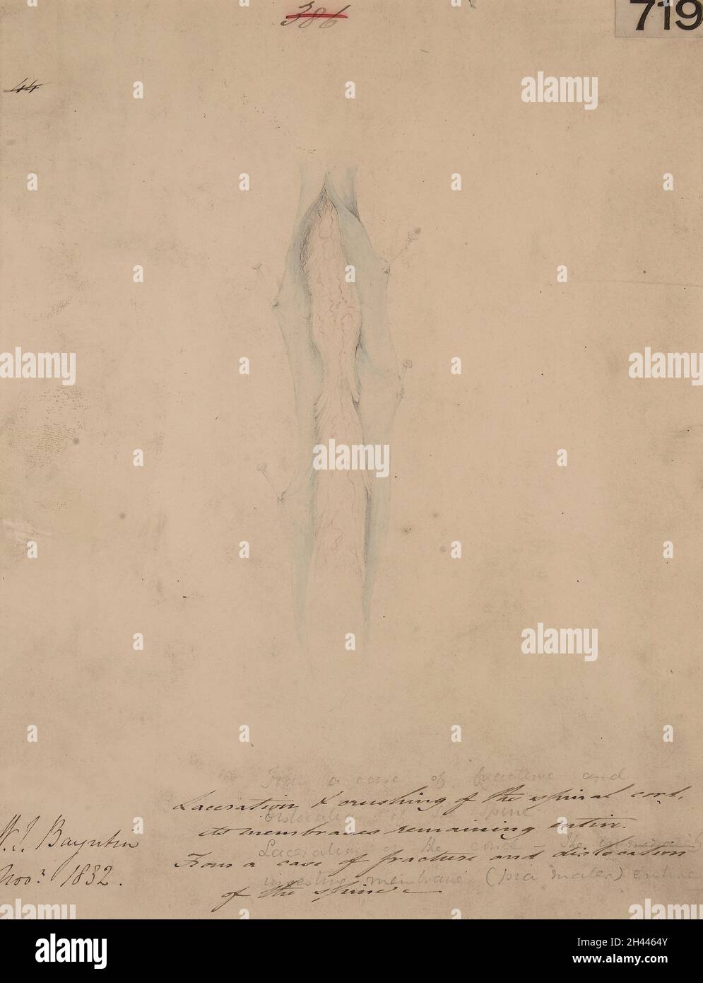 Spinal cord crushed by a fracture and dislocation of the spine Stock ...