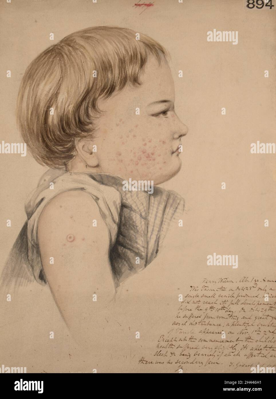 Eruption on the skin appearing nine or ten days after vaccination Stock ...