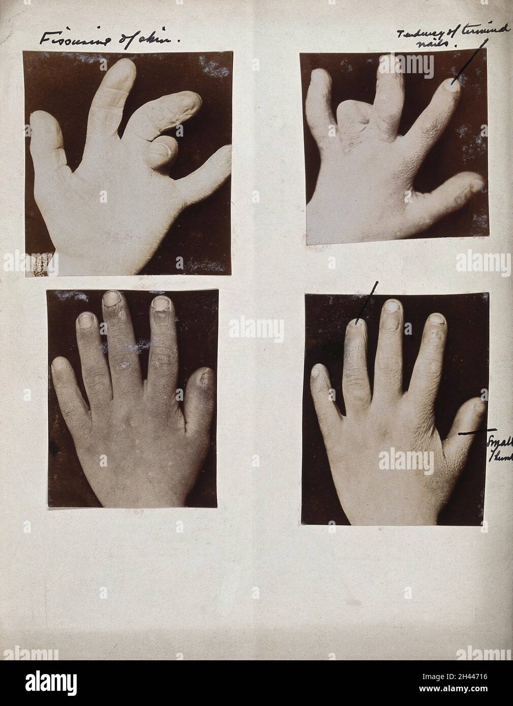 Down's syndrome affecting the hands and fingers. Four photographs Stock ...