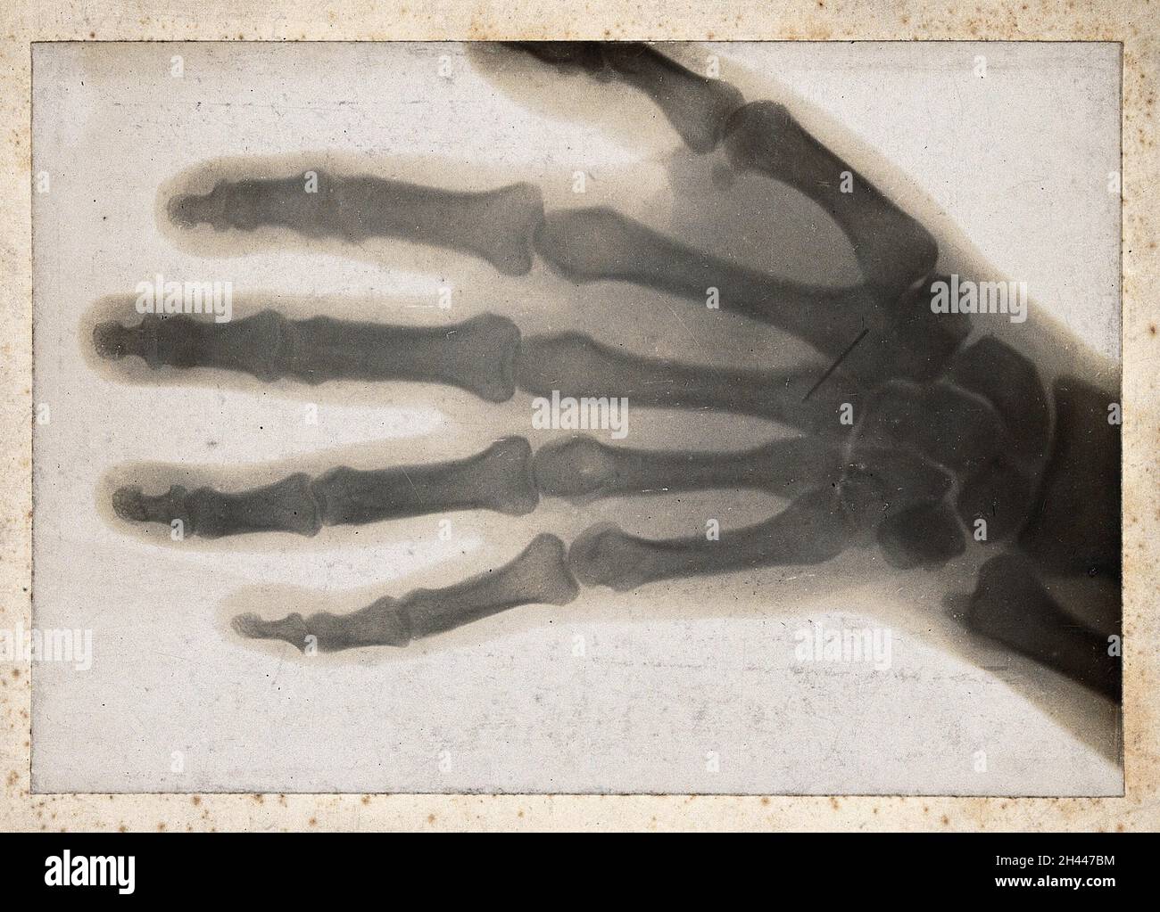 The bones of a hand, viewed through x-ray; possibly with a needle just ...