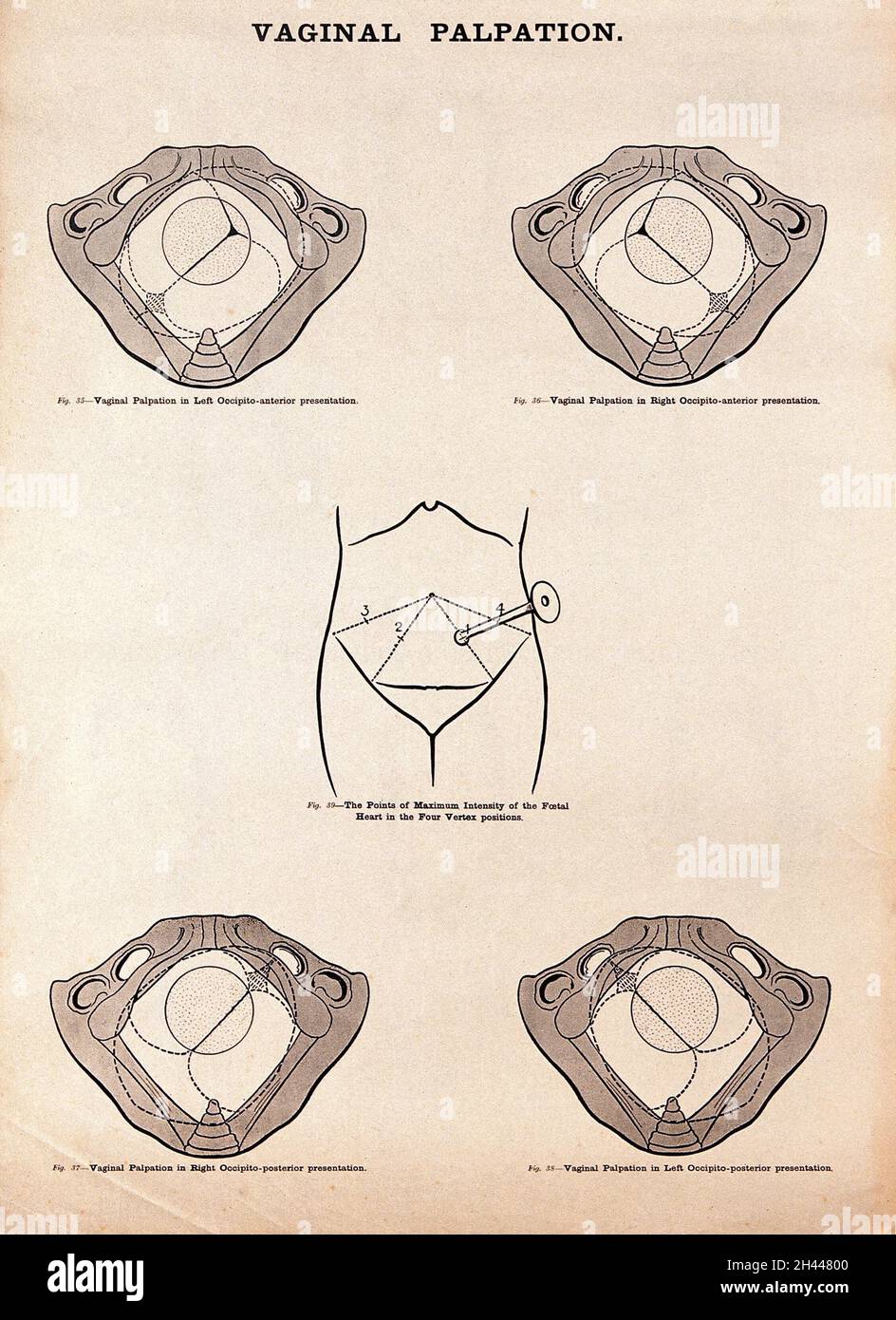 Vaginal palpation in pregnancy. Lithograph after W. F. Victor Bonney ...