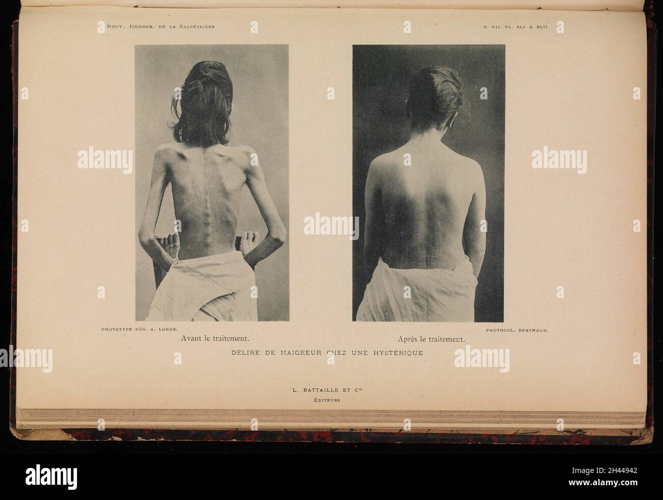 Two photographs, before and after treatment for anorexia Stock Photo ...