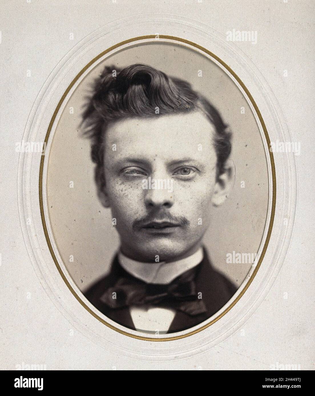 A man's head; his left eye is smaller than his right. Photograph by L ...