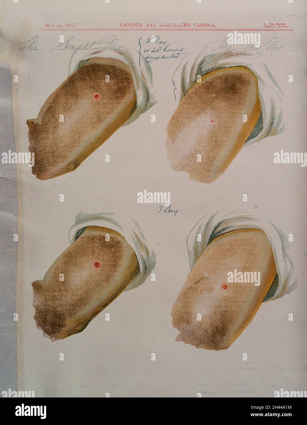 A comparison between smallpox and cowpox pustules on the 2nd and 3rd ...