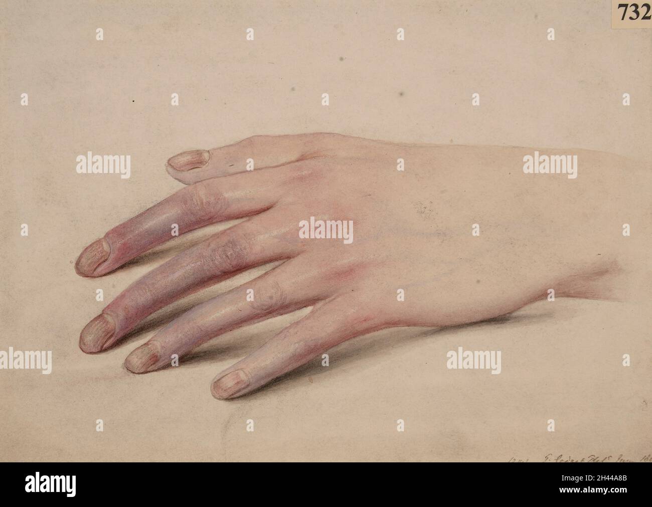Trophic changes in the hand of a patient whose median nerve was divided ...
