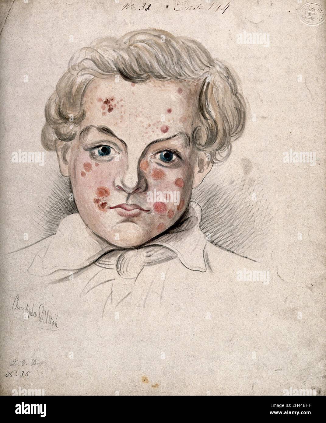 Sores and areas of diseased skin on the face of a boy. Watercolour by C ...