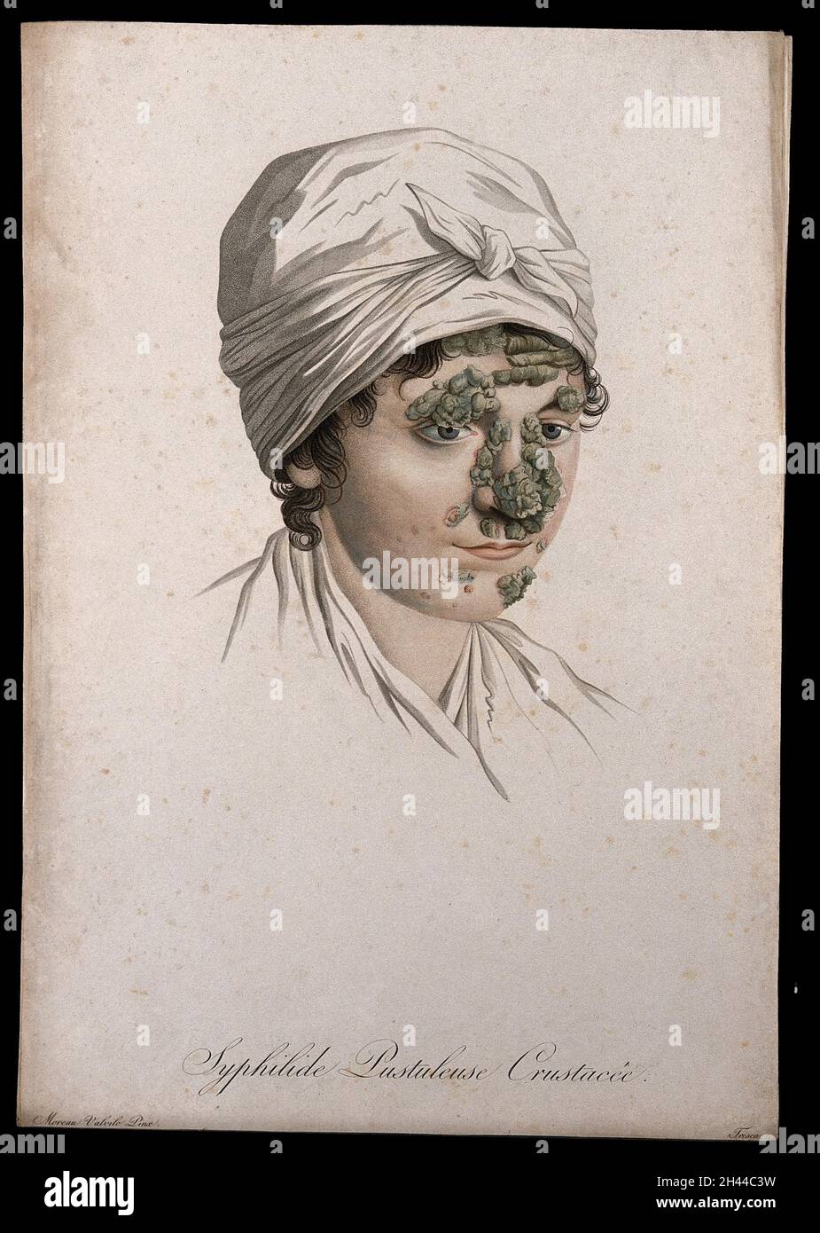 A woman with a skin disease on her face. Coloured stipple engraving by ...