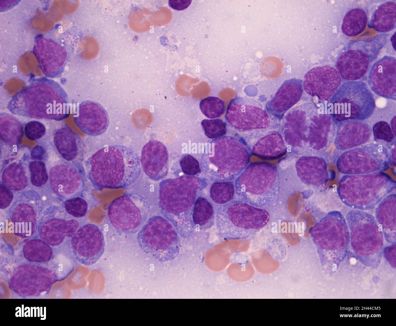 NK T-cell lymphoma is a highly aggressive cancer of a specific type of ...